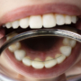 Orthodontic Retainer Replacement | Clear Retainers Near Aurora